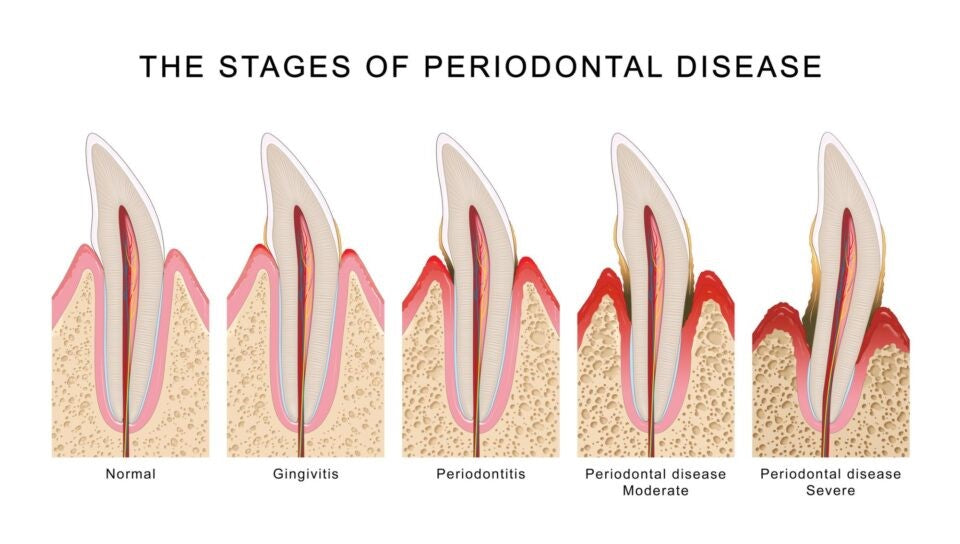 How Long Does It Take For Gingivitis to Turn Into Periodontitis? – The ...